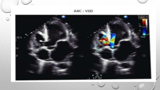 VSD ECHO.pptx