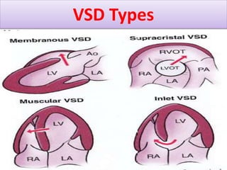 An approach to a patient with ventricular septal defect | PPSX