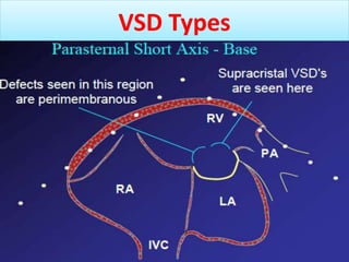 An approach to a patient with ventricular septal defect | PPSX