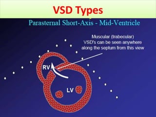 An approach to a patient with ventricular septal defect | PPSX