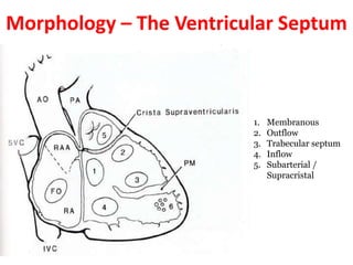 An approach to a patient with ventricular septal defect | PPSX