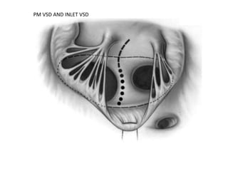 MANAGEMENT OF VSD | PPTX