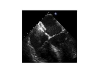 Complex VSD closure with Pseudoaneurysm and PFO | PPT