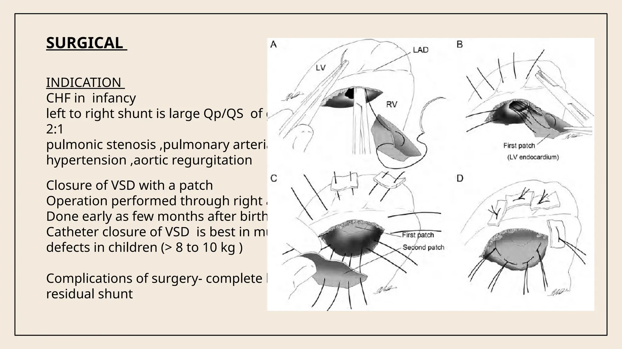 Ventricular Septal Defect, investigations and management. Pediatrics | PPTX