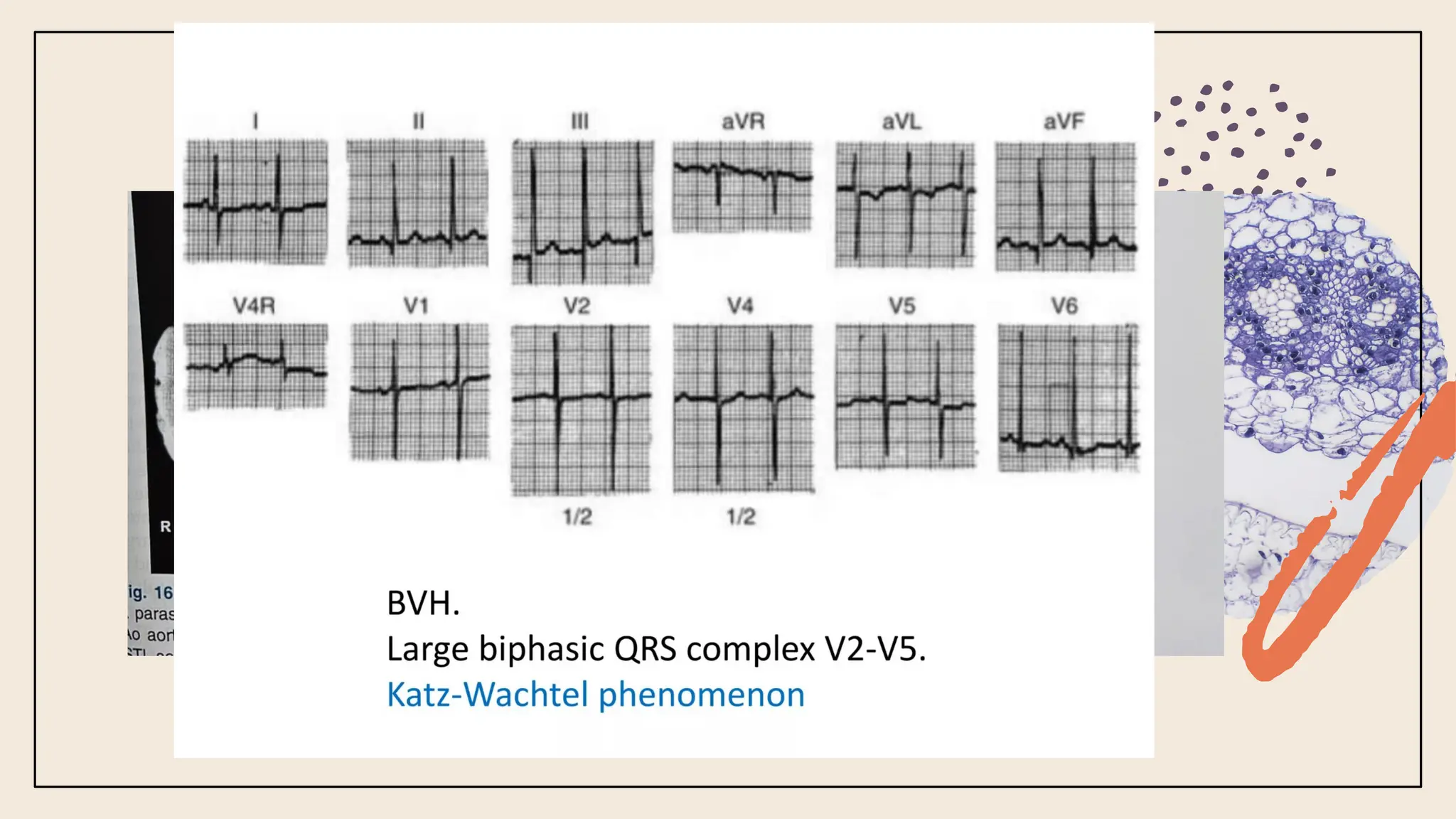 Ventricular Septal Defect, investigations and management. Pediatrics | PPT