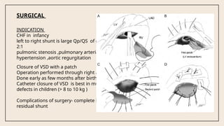 Ventricular Septal Defect, investigations and management. Pediatrics | PPTX