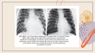 Ventricular Septal Defect, investigations and management. Pediatrics | PPTX