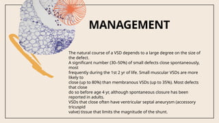 Ventricular Septal Defect, investigations and management. Pediatrics | PPTX