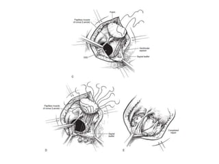 Vsd surgery | PPTX