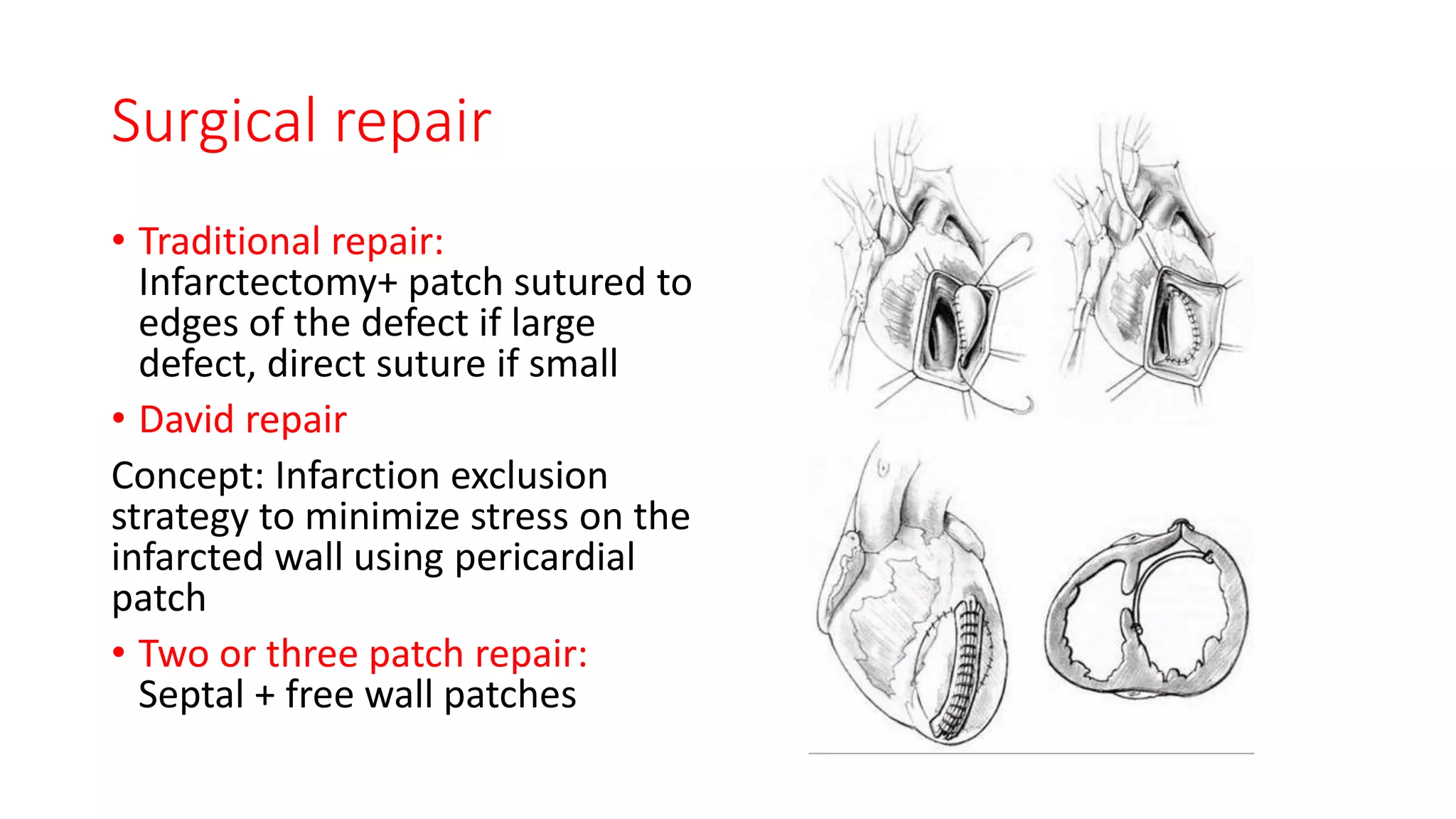 Ventricular septal rupture .pptx | First Aid | Injuries