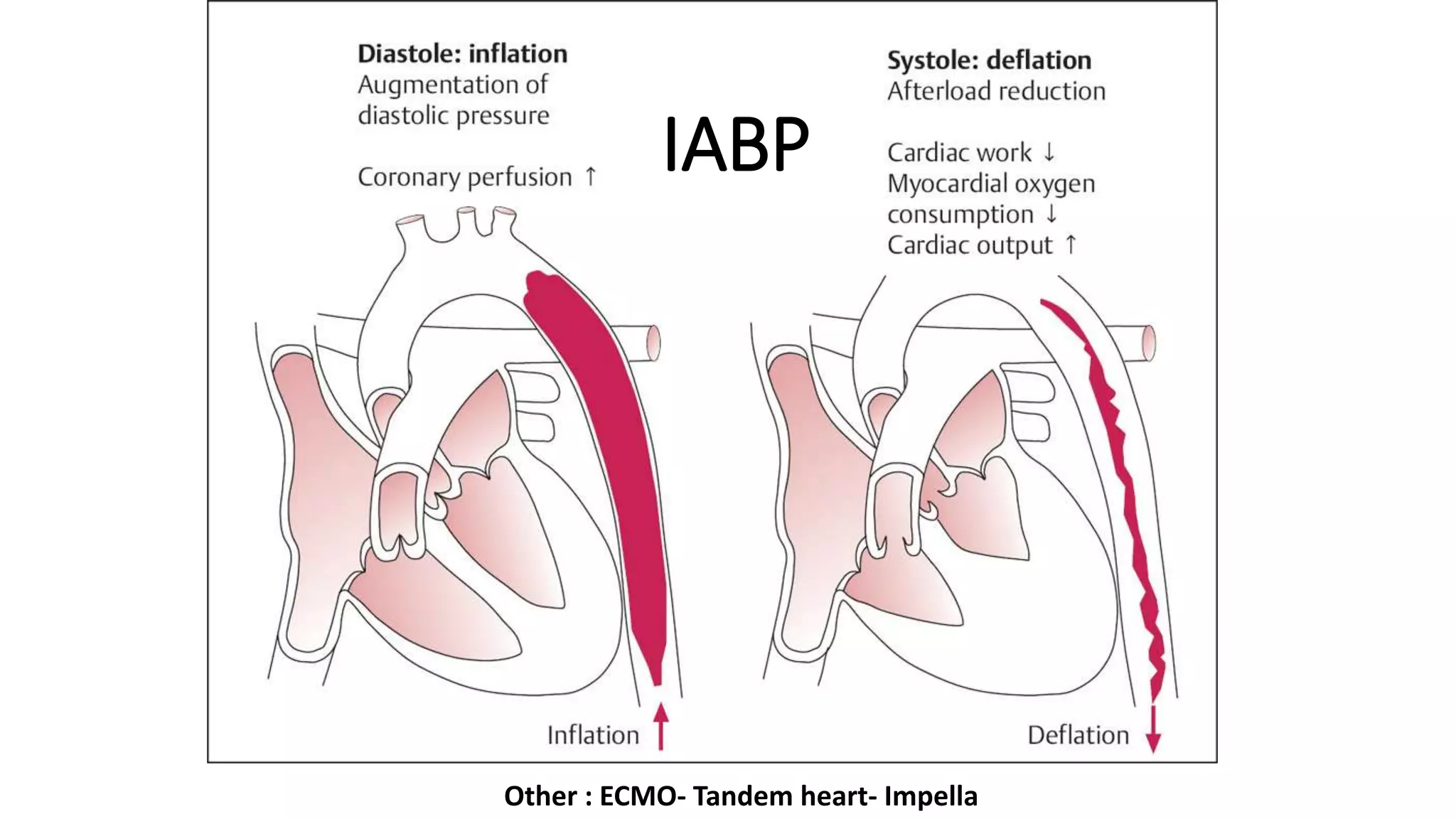 Ventricular septal rupture .pptx | First Aid | Injuries