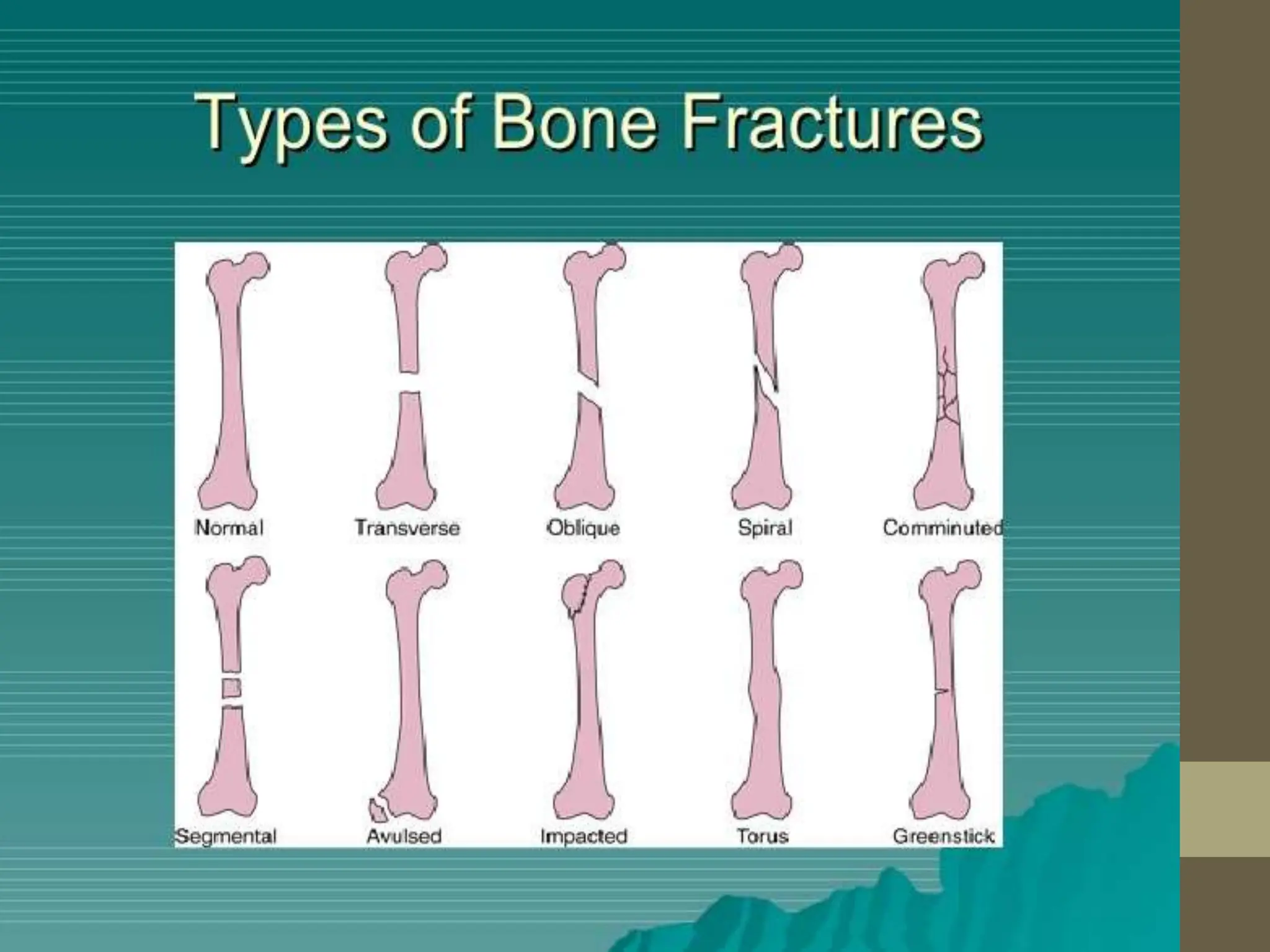 VSR610_PPT_Fracture.pptx classification of fractures | PPTX