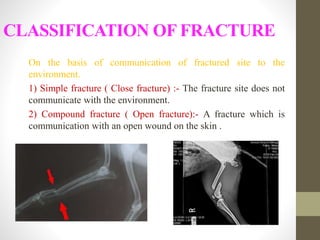 VSR610_PPT_Fracture.pptx classification of fractures | PPTX