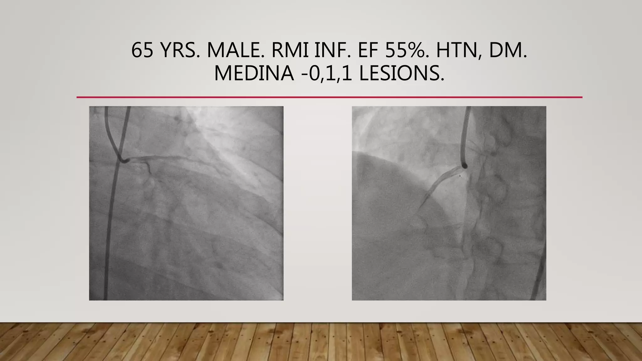 Interventional Cardiology. Coronary , PCI -V stenting | PPTX