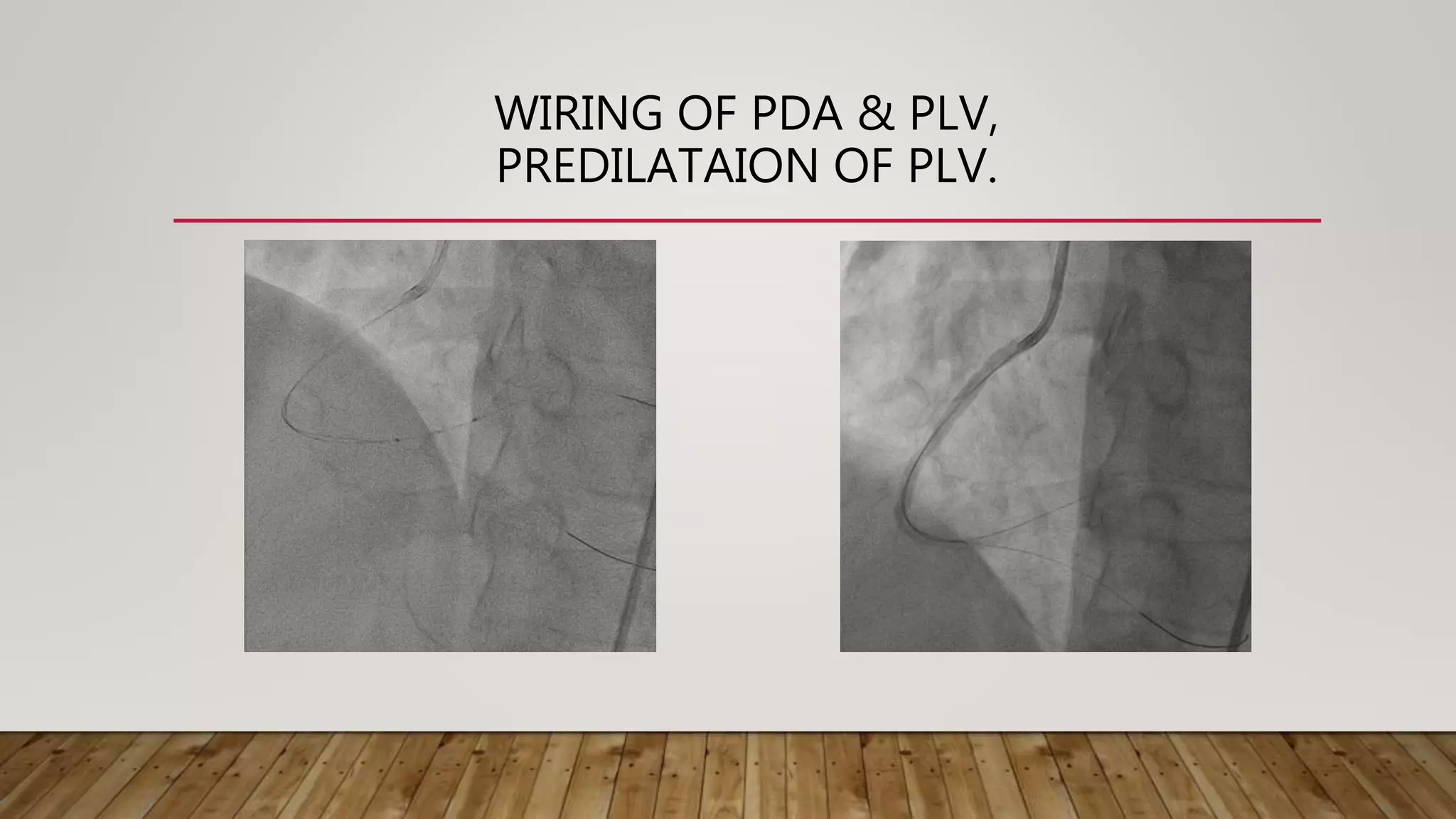 Interventional Cardiology. Coronary , PCI -V stenting | PPTX