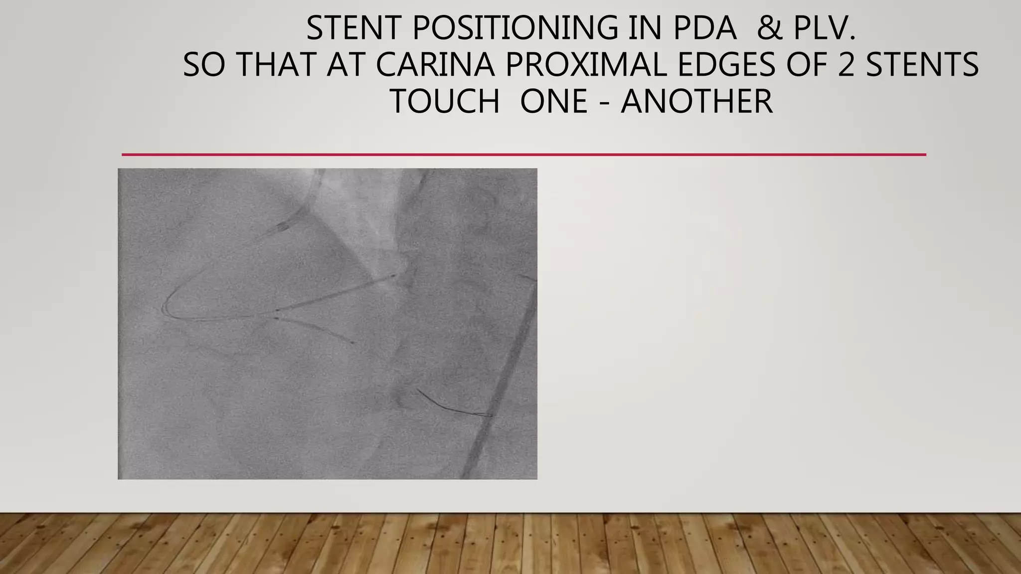 Interventional Cardiology. Coronary , PCI -V stenting | PPTX