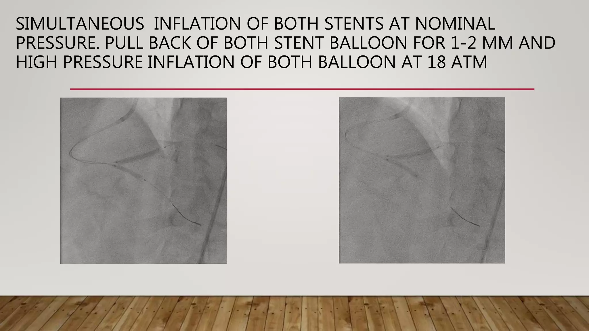 Interventional Cardiology. Coronary , PCI -V stenting | PPTX