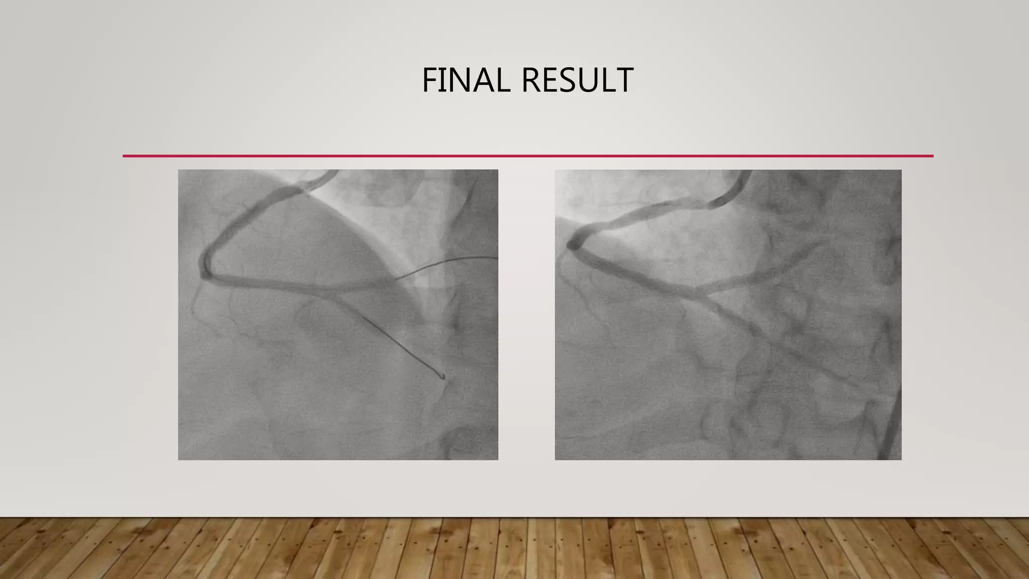 Interventional Cardiology. Coronary , PCI -V stenting | PPTX