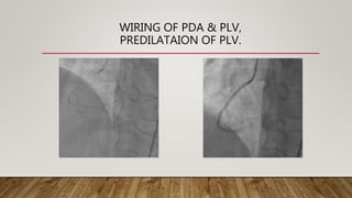 Interventional Cardiology. Coronary , PCI -V stenting | PPTX