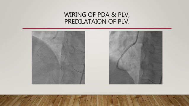 Interventional Cardiology. Coronary , PCI -V stenting | PPTX