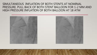 Interventional Cardiology. Coronary , PCI -V stenting | PPTX