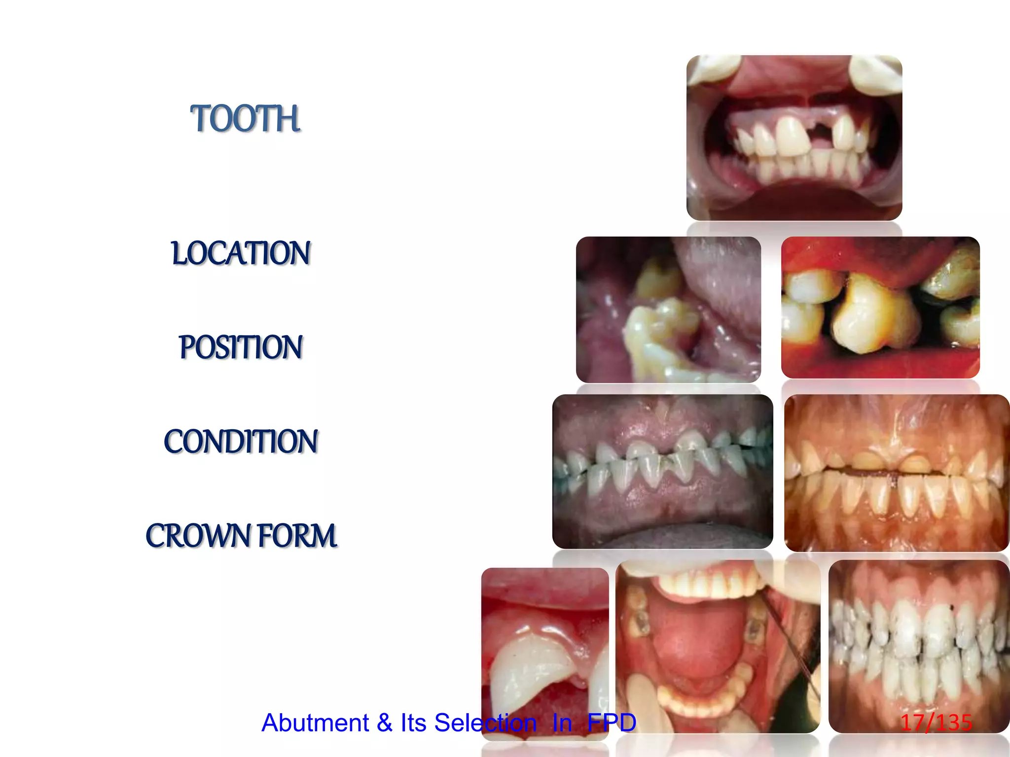 Abutment & Its Selection In Fixed Partial Denture | PPTX