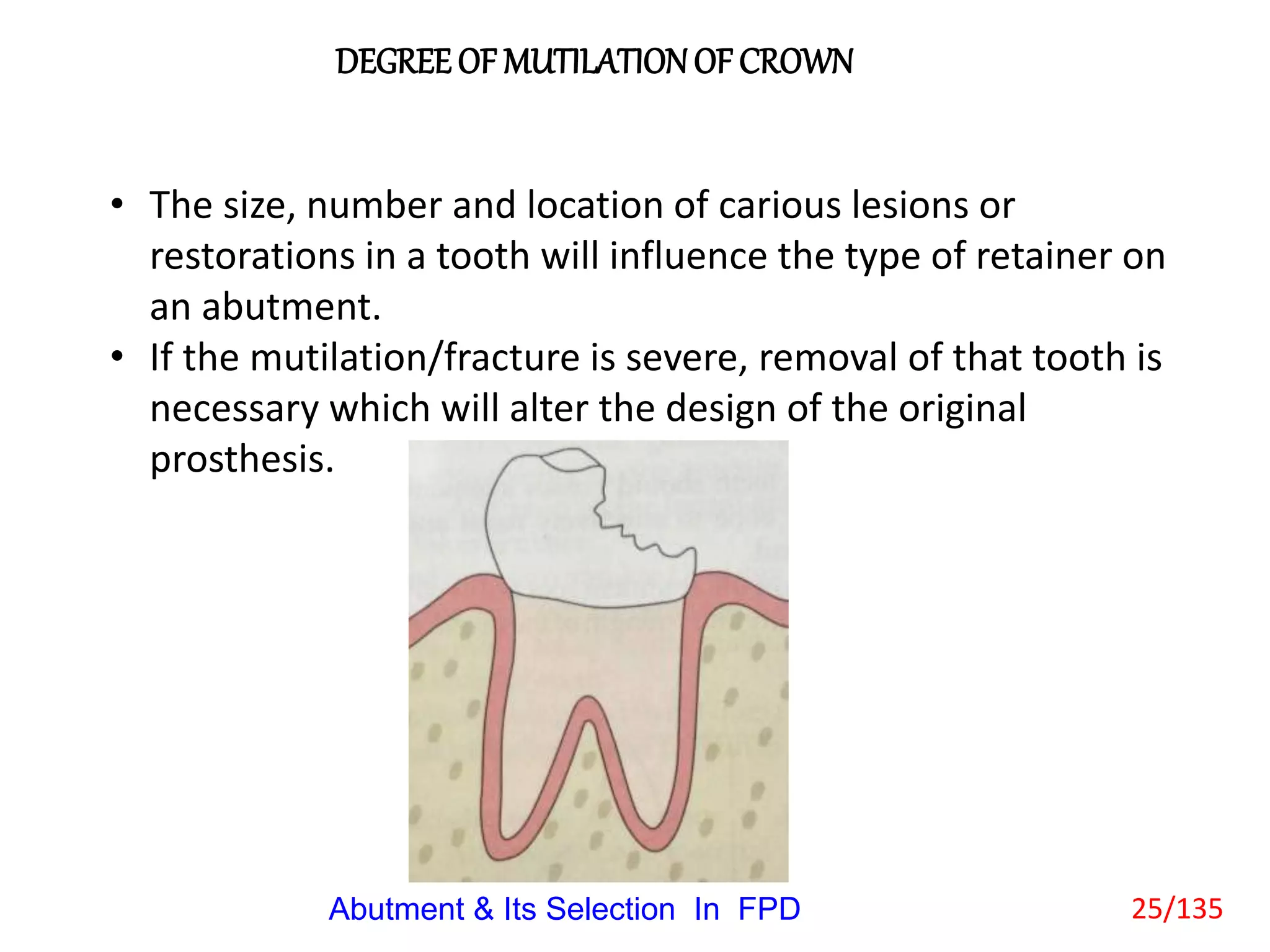 Abutment & Its Selection In Fixed Partial Denture | PPTX