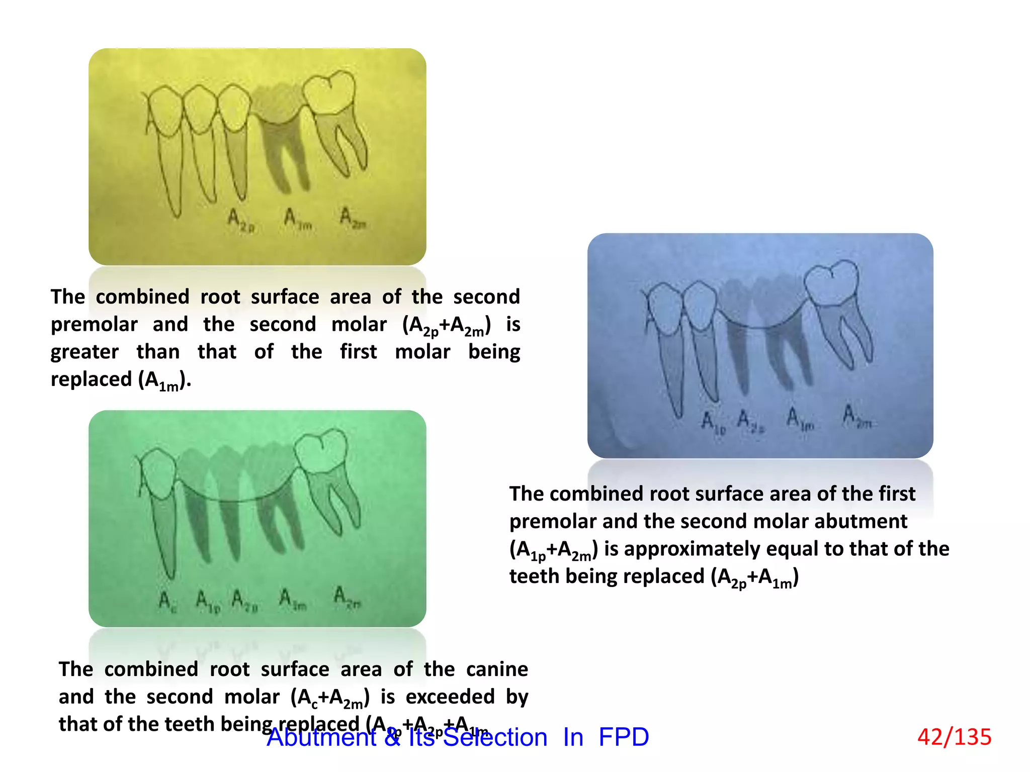 Abutment & Its Selection In Fixed Partial Denture | PPTX