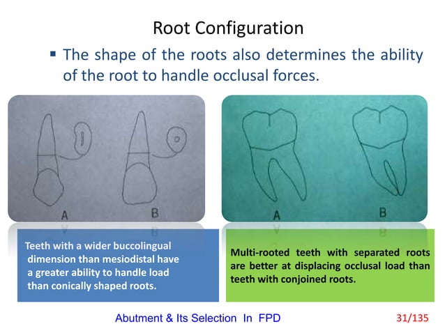 Abutment & Its Selection In Fixed Partial Denture | PPTX