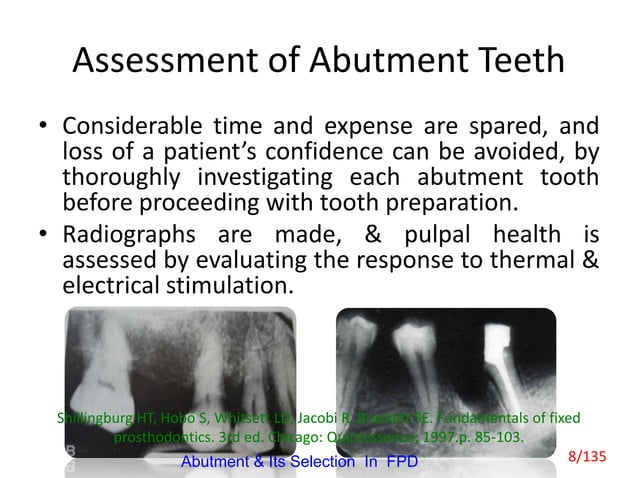 Abutment & Its Selection In Fixed Partial Denture | PPTX