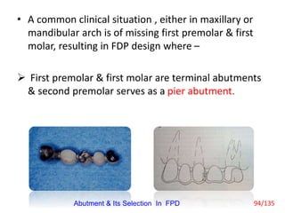Abutment & Its Selection In Fixed Partial Denture | PPTX