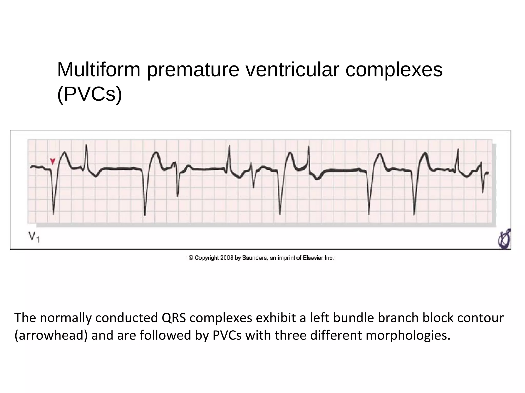 Ventricular arrhythmias | PPT