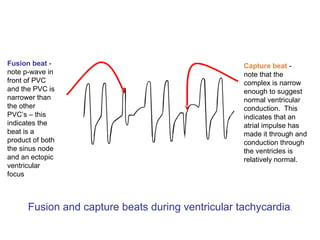 Ventricular arrhythmias | PPT