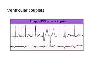 Ventricular Couplets
