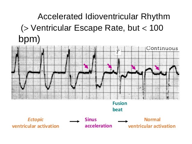 Ventricular arrhythmias
