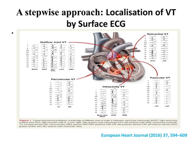 CATHETER ABLATION IN VT | PPTX