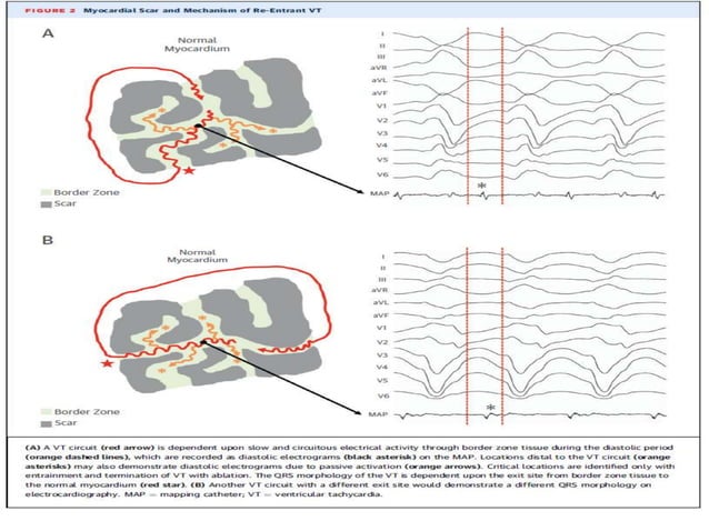CATHETER ABLATION IN VT | PPTX