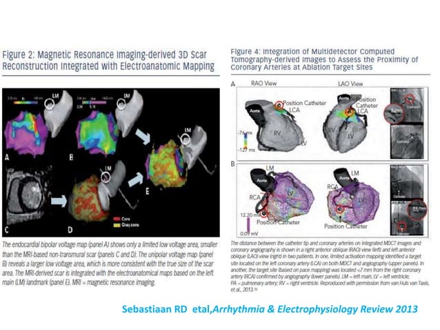 CATHETER ABLATION IN VT | PPTX