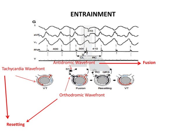 CATHETER ABLATION IN VT | PPTX