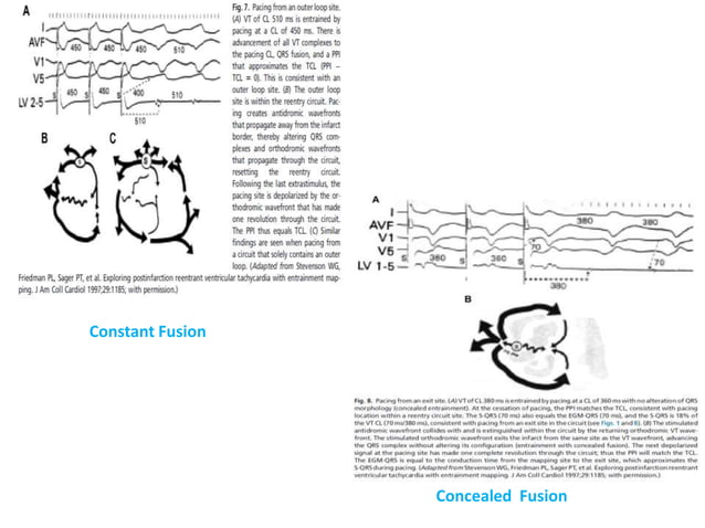 CATHETER ABLATION IN VT | PPTX