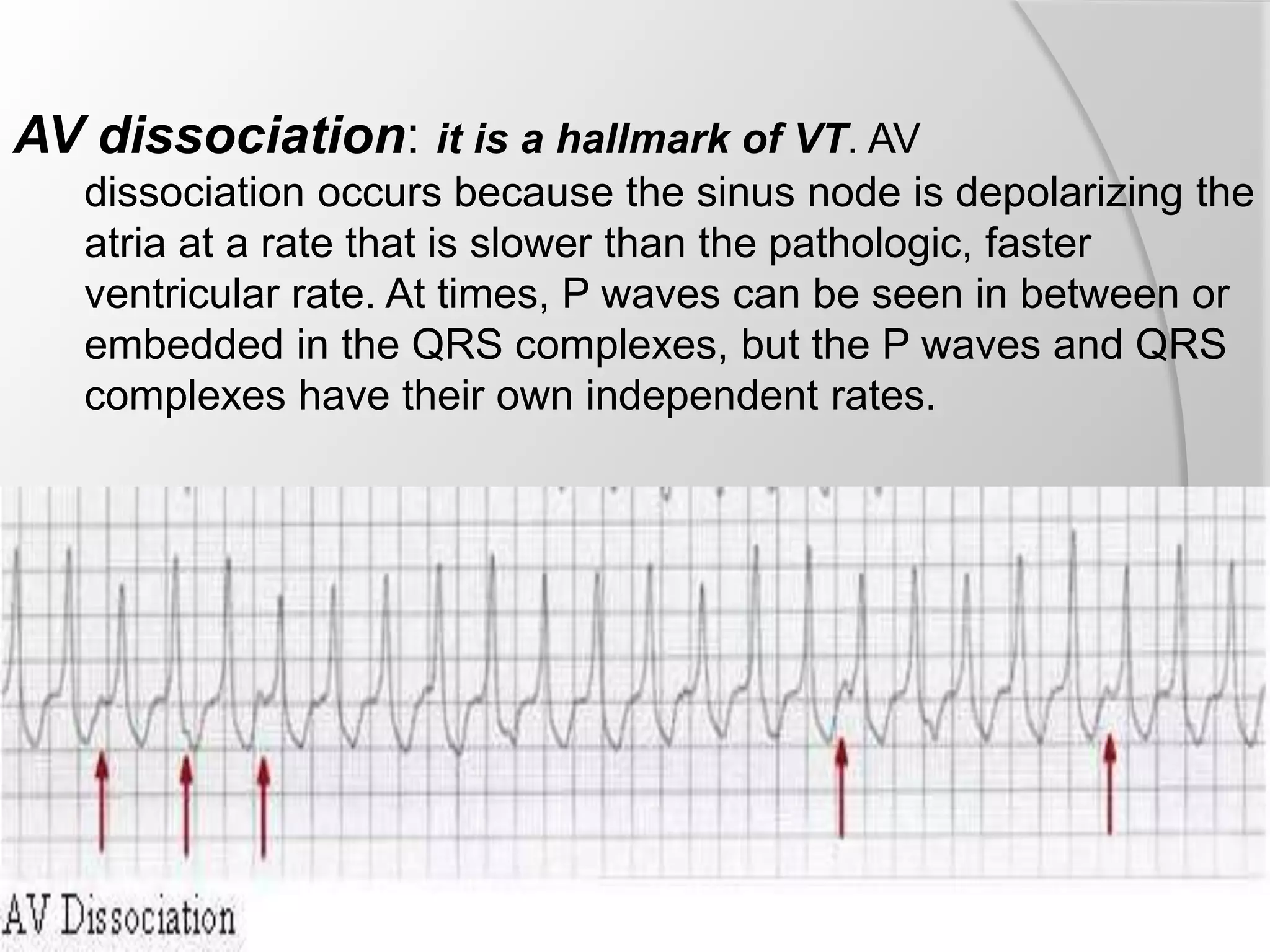 Ventricular tachycardia by dr.muzahid | PPTX | Heart and Cardiovascular ...