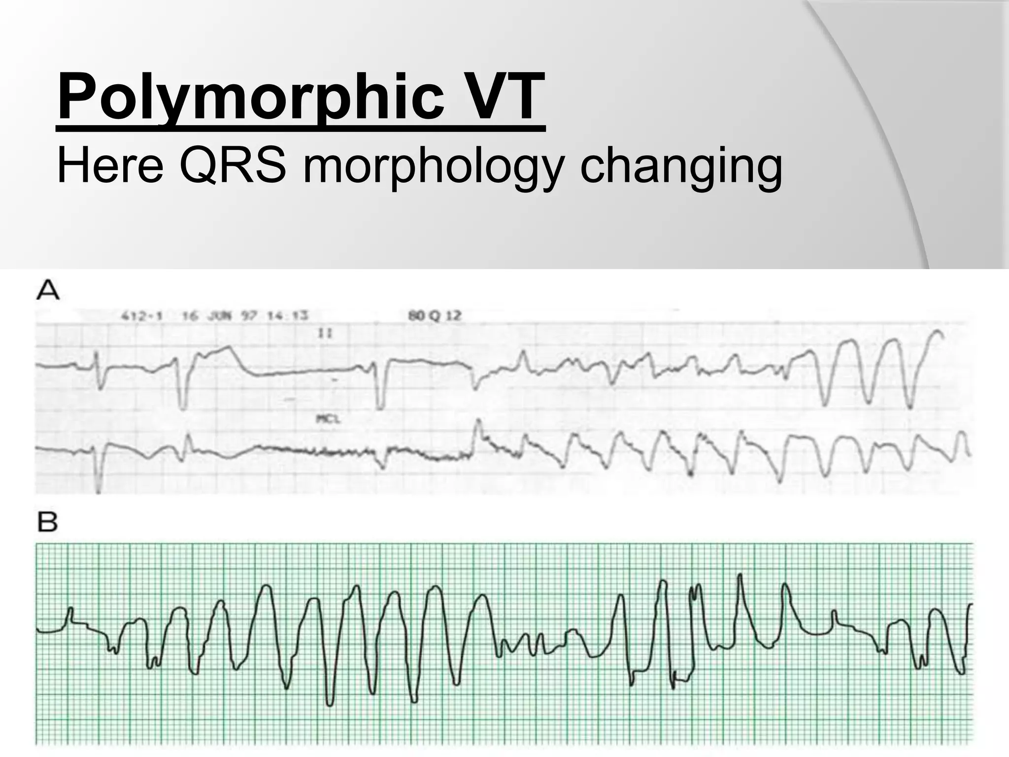 Ventricular tachycardia by dr.muzahid | PPTX | Heart and Cardiovascular ...