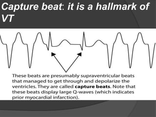 Ventricular tachycardia by dr.muzahid | PPTX | Heart and Cardiovascular ...