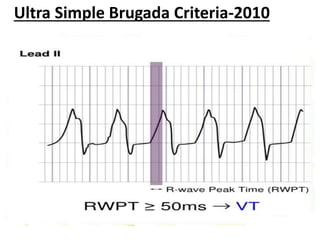 Ventricular tachycardia by dr.muzahid | PPTX | Heart and Cardiovascular ...
