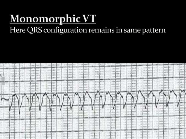 Ventricular tachycardia by dr.muzahid | PPTX | Heart and Cardiovascular ...