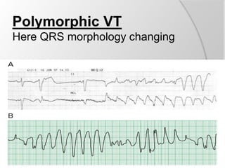 Ventricular tachycardia by dr.muzahid | PPTX | Heart and Cardiovascular ...
