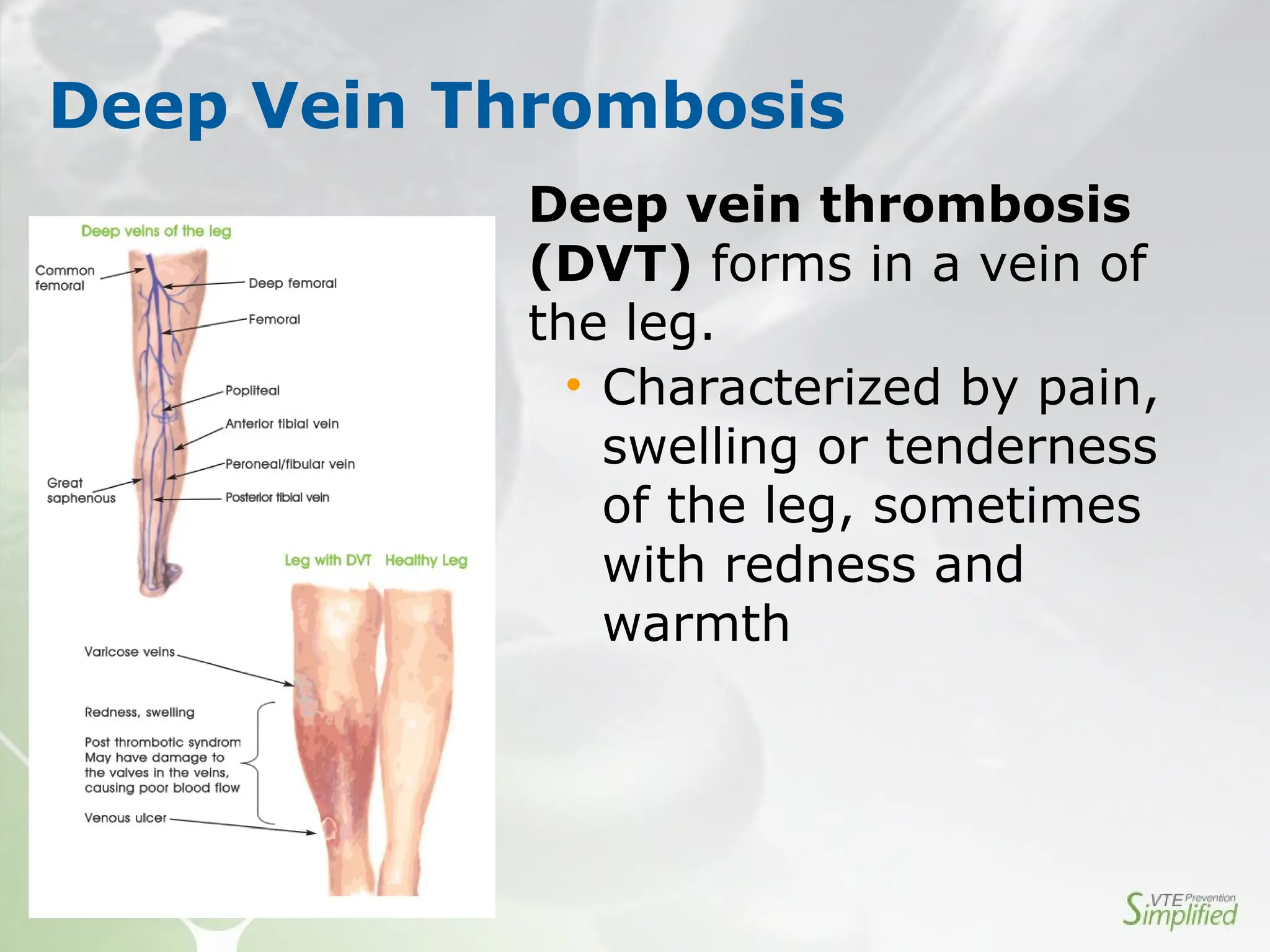 VTE prophylaxis simplified focus on prevention.ppt