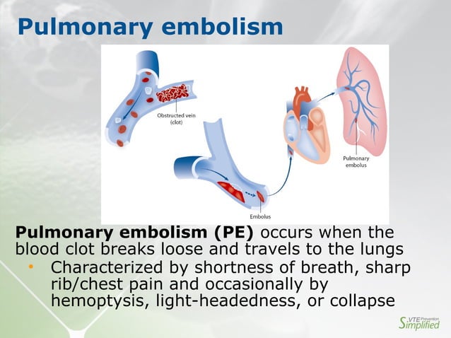 VTE prophylaxis simplified focus on prevention.ppt