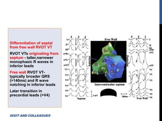 VT in structurally normal heart | PPTX