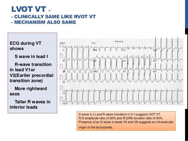 VT in structurally normal heart